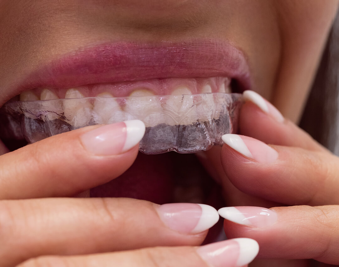 Clear-Lock Retainers in Forest Hills | Madison Dental