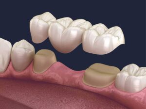 Dental Crown Procedure Steps: A Complete Guide | Madison Dental Art