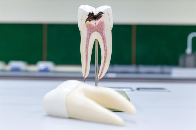 Alternatives to Root Canal: What Are Your Options? | Madison Dental Art