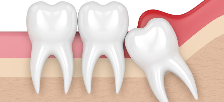 Impacted Wisdom Teeth Removal Surgery: What to Expect, Recovery & Cost ...