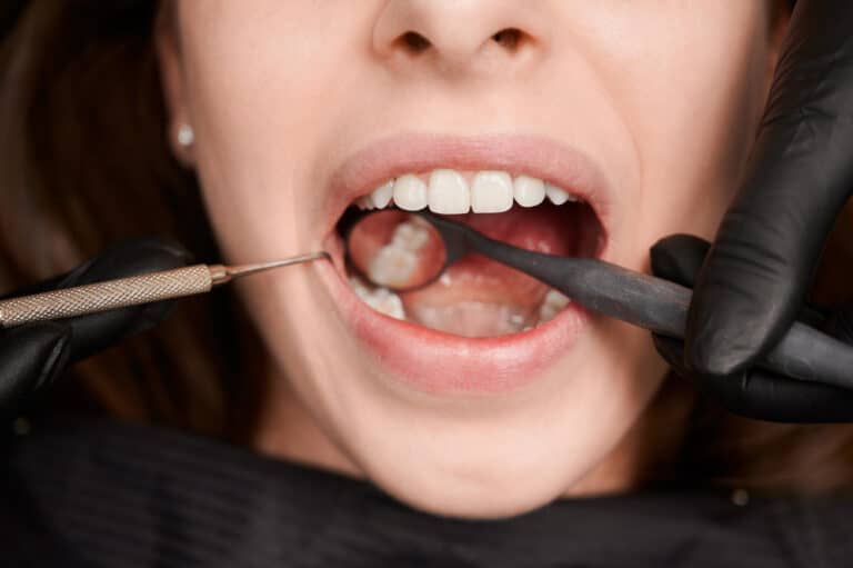 Can Grinding Teeth Cause Cavities and Damage Your Teeth Over Time ...